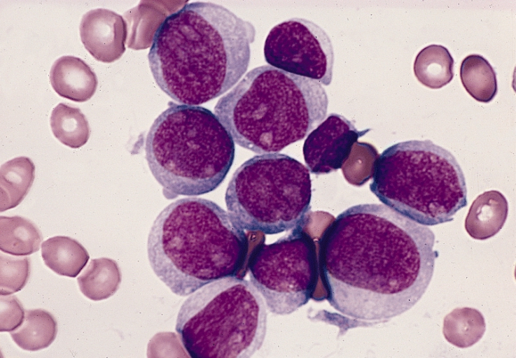 Marker for therapy response in acute myeloid leukemia (AML) identified ...