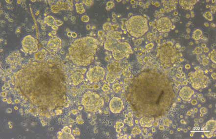 New approaches against metastatic breast cancer: mini-tumors from ...