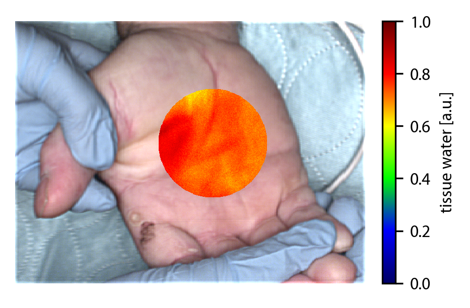 Faster sepsis diagnosis through hyperspectral imaging and AI - German ...